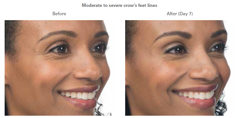 Botox Injections | Smooth Wrinkles & Fine Lines in St. Louis
