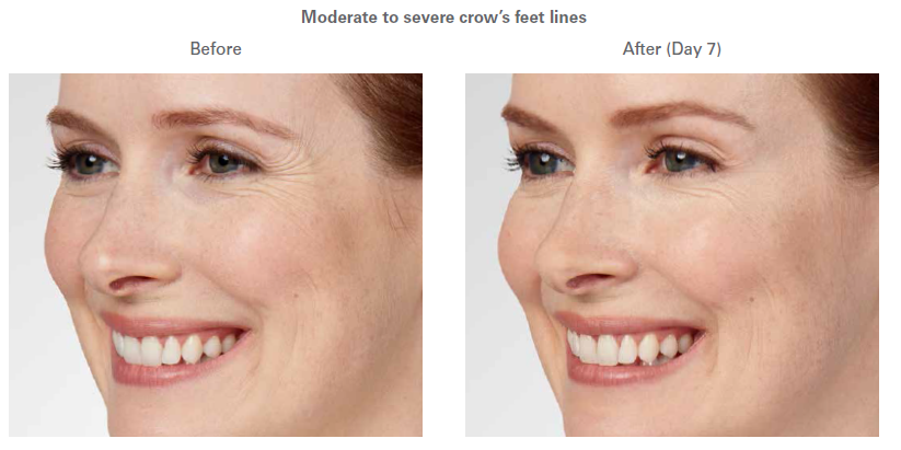 BOTOX® Cosmetic St. Louis MO